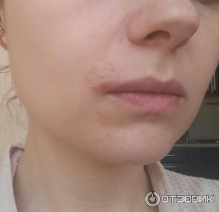 Отзыв о Пластырь антигерпетический маскирующий Compeed | Всё же герпес ...